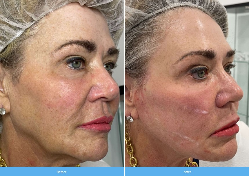 Thread Lift Beauty Medica Thread Lift Beauty Medica