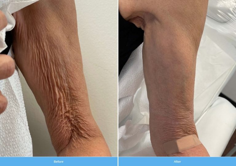 Thread Lift | Beauty Medica